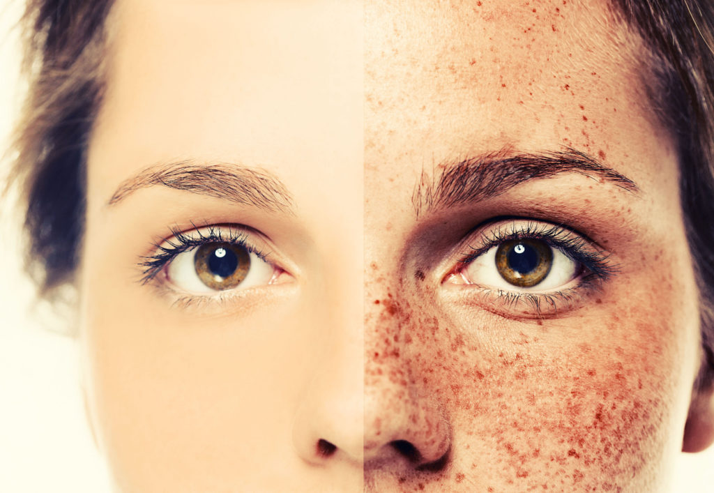 How To Lighten Freckles - Women Stuff How To Lighten Freckles